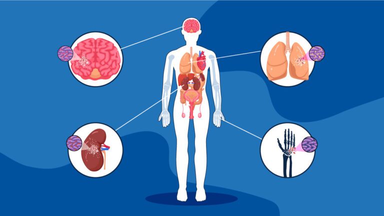 (Semana 11) LA TUBERCULOSIS EN NUESTRO PAIS - Sanatrix Clínica